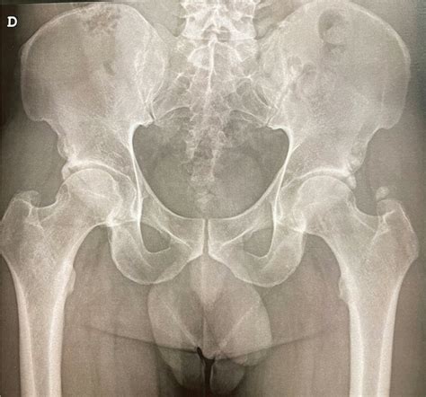 Plain X Ray Of The Sacroiliac Joints Showing Signs Of Sacroiliitis