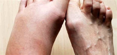 Treat Bee Sting On Foot