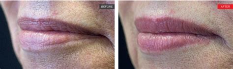 Traitement Laser Fotona LipLase Beauté Santé Anne Bélanger