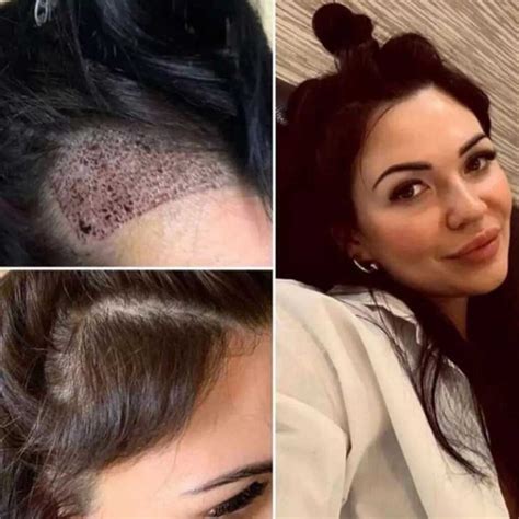 Greffe cheveux femme avant après Esthetic Clinic Turkey