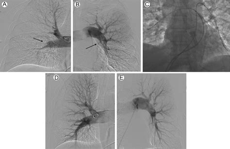 Catheter Directed Thrombolysis For Pulmonary Embolism The State Of