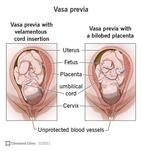 Vasa Previa Causes Symptoms Management Treatment