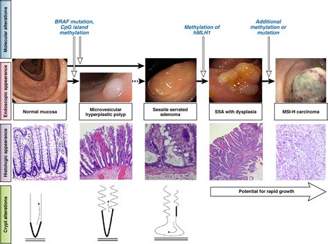 endoscopic and histologic features of sessile serrated polyps and my xxx hot girl