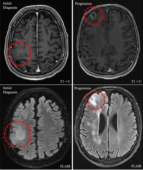 Brain Tumor Mri Without Contrast