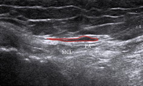 Accuracy And Efficacy Of Ultrasound Guided Pes Anserinus Bursa