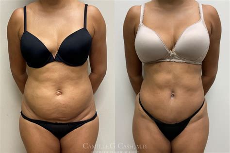 Mini Tummy Tuck Before And After