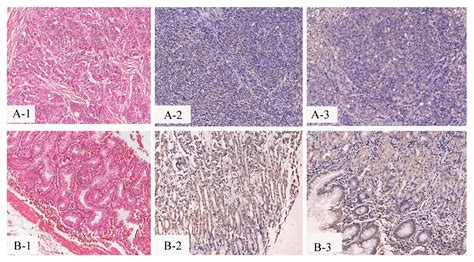 Protein Inhibitor Of Activated STAT 1 Is Downregulated In Gastric