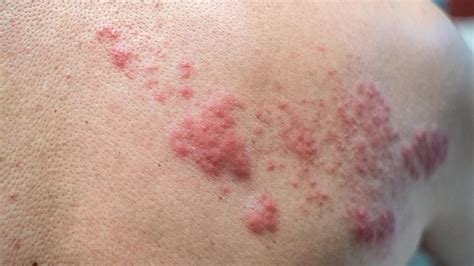 Qu Es El Herpes Z Ster S Ntomas Causas Y C Mo Tratar La Enfermedad