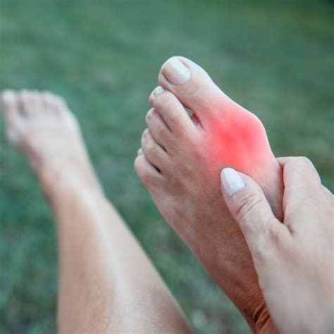 Bunions Understanding The Causes Symptoms And Treatment Options