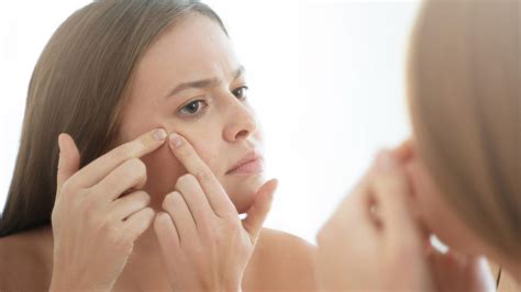 Pimple Popping Dr Zac Turner On How To Safely Pop Spots News Au