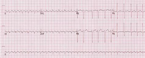 Las 5 Arritmias Que Debes Saber Identificar En El ECG Cardiology