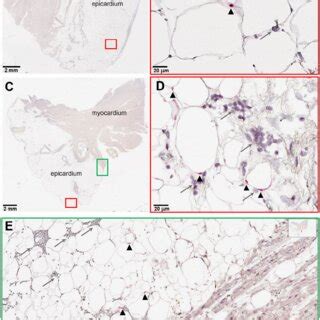 SARS CoV 2 RNA And Immune Infiltration Are Present In Adipose Tissue Of