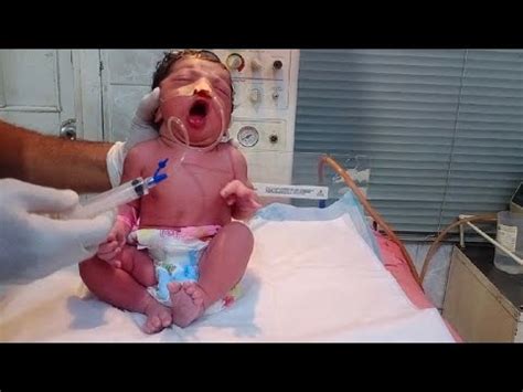 New Born Baby Inhale Meconium Fluid Wash The Stomach By N S Pass Ng