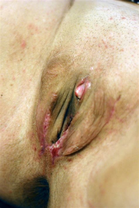 Post Op Transgender Vagina Close Up Sexy Photos Pheonix Money