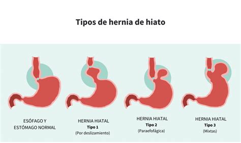 Todo sobre las hernias de hiato causas síntomas y tratamiento