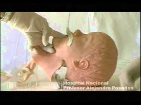 Fijación de Tubo Endotraqueal en Pediatría Hospital A Posadas wmv
