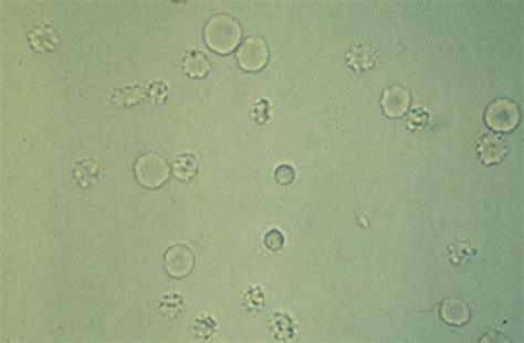 Urine Sediment Id Clinpath Flashcards Quizlet