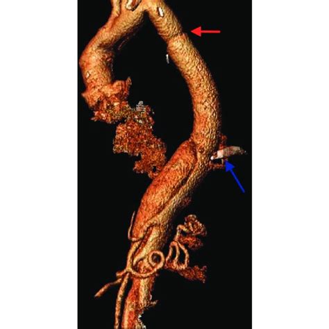 Three Dimensional Reconstruction Of The Thoracoabdominal Aorta Showing