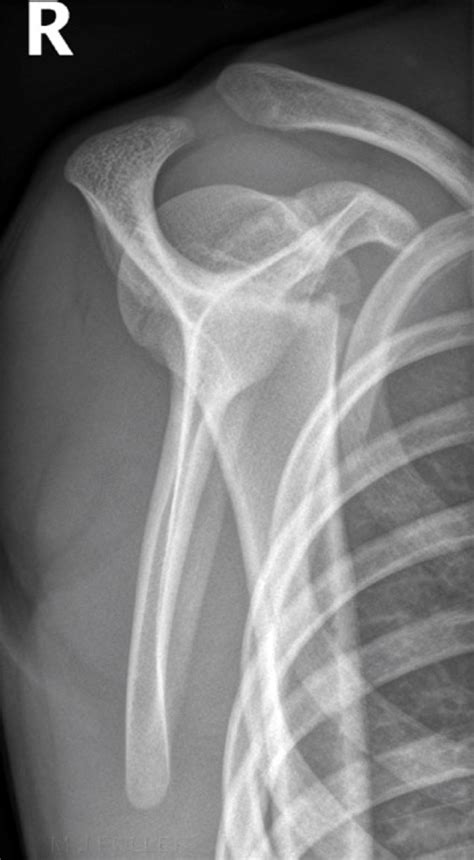 Shoulder Scapular Y Diagram Quizlet