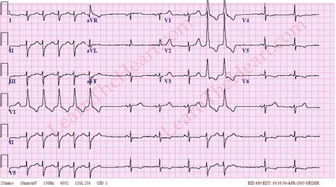 Ventricular Tachycardia Ecg