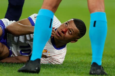 Bombazo Kylian Mbappé sufre una fractura de nariz en el debut de la