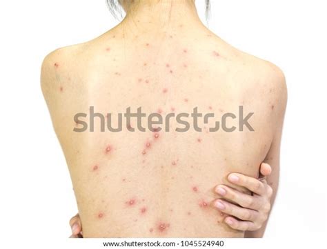 Closeup Girl Back Blisters Scar Rash Stock Photo 1045524940 Shutterstock