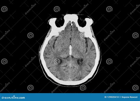 CT Scan Intracerebral Hemorrhage Stock Photo Image Of Medical Human