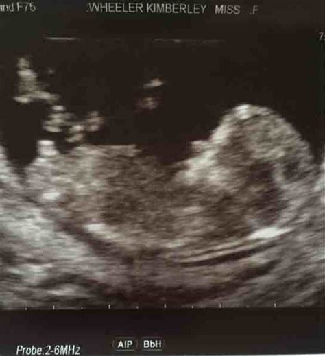 Gender Guesses From 12 Week Scan