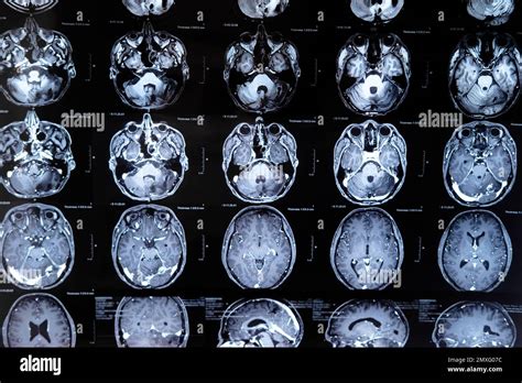 rm con tumor cerebral Imágenes por resonancia magnética Fotografía de