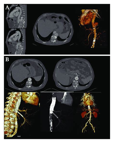 A Thoraco Abdominal Transition Penetrating Aortic Ulcer Pau