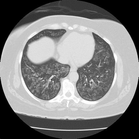 Radiopaedia Case Pulmonary Alveolar Proteinosis Id Study