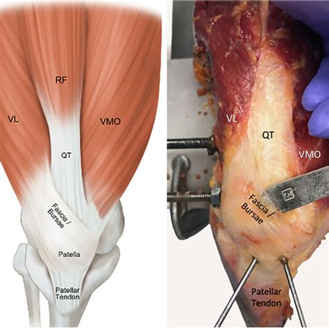 The Third Layer Of The Quadriceps Tendon Consisting Of The Vastus