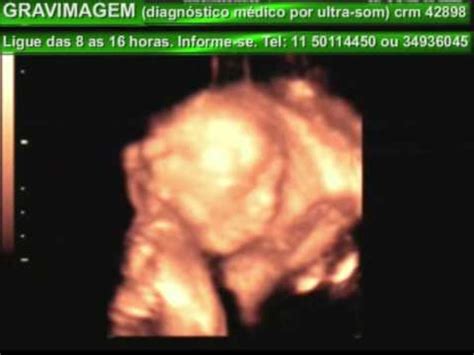 20091229 1084 ULTRA SOM 3D 4D GRAVIDEZ GEMELAR 21 SEMANAS YouTube