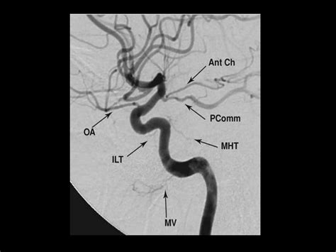Cerebral Vascular Anatomy And Technique PPT
