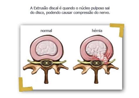 H Rnia De Disco Dr William Zarza