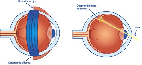 Desprendimiento de Retina Síntomas causas y operación Oftalvist