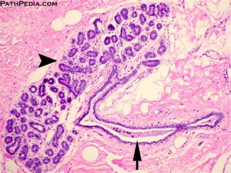 P Breast Pathology Flashcards Quizlet