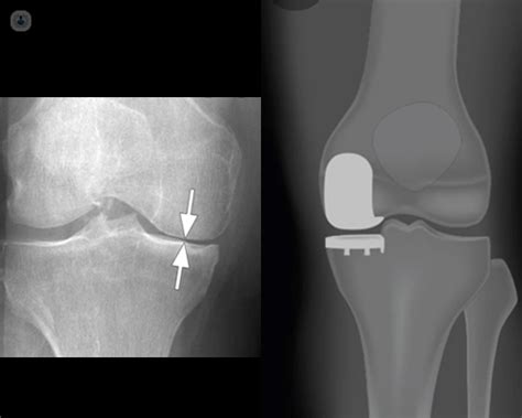 Partial Vs Total Knee Replacement Top Doctors
