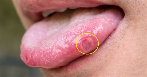 Por Qu Salen Llagas En La Boca Salud