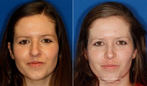 Bulbous Rounded Tip Rhinoplasty In Seattle Rhinoplasty Surgeon