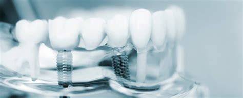 Comment se déroule la pose dun implant dentaire Dr Elhyani Paris