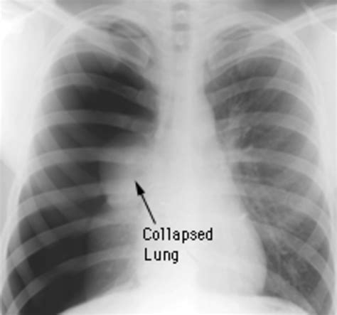X Ray Diagnostics Of Pneumothorax Radiographic Representations Of The