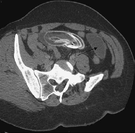 Tomodensitométrie abdominopelvienne Download Scientific Diagram