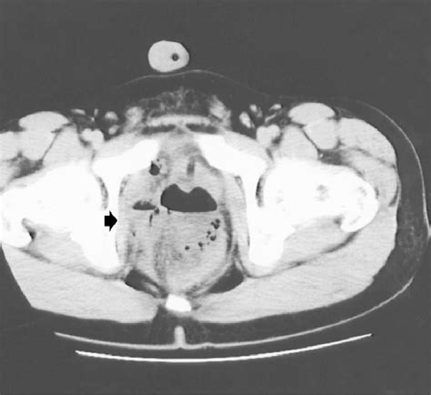 Computed Tomography Scan Showing Fluid Accumulation Accompanied By Free