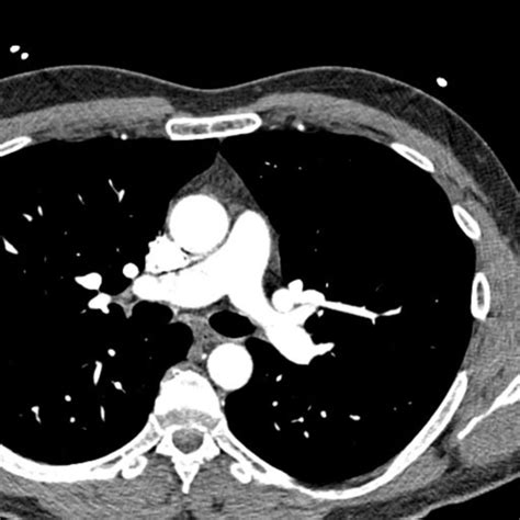 Normal Ct Thorax