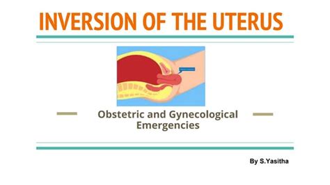 Inversion Of The Uterus Pptx