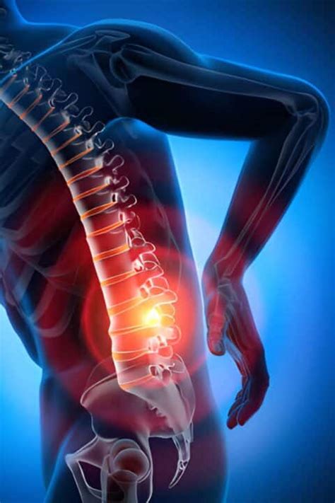 Hernia Discal Oviedo Cl Nica Rub N Martino