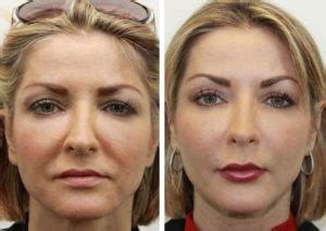 Lipofilling Visage Tunisie Prix Lipofilling Injection De Graisse Au