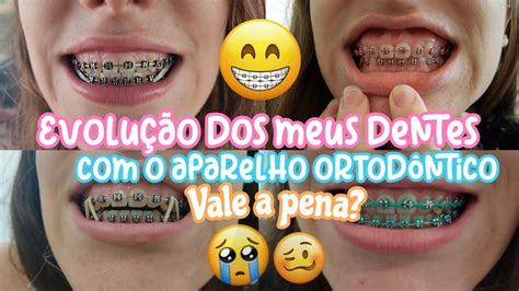 Mudan As Nos Dentes O Aparelho Ortod Ntico Vale A Pena Fotos