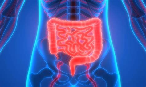Qué es la diverticulitis síntomas y causas